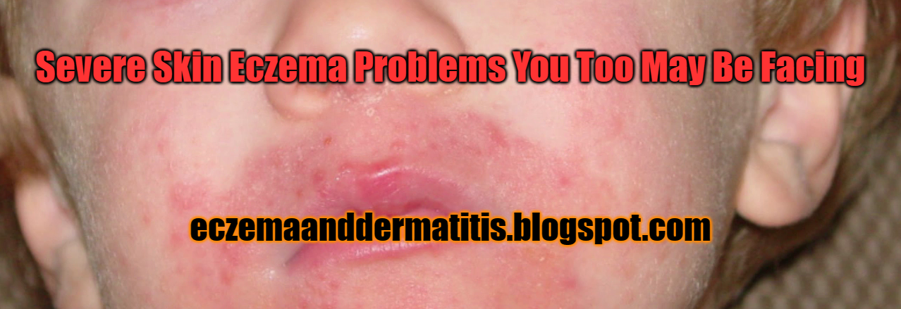 Severe Skin Eczema Problems You Too May Be Facing - Eczema and Dermatitis
