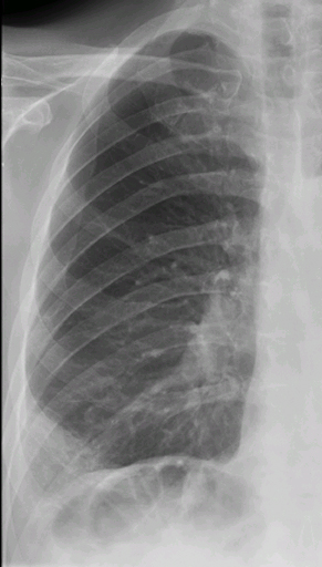 ABC Radiology Blog: Hampton's hump sign