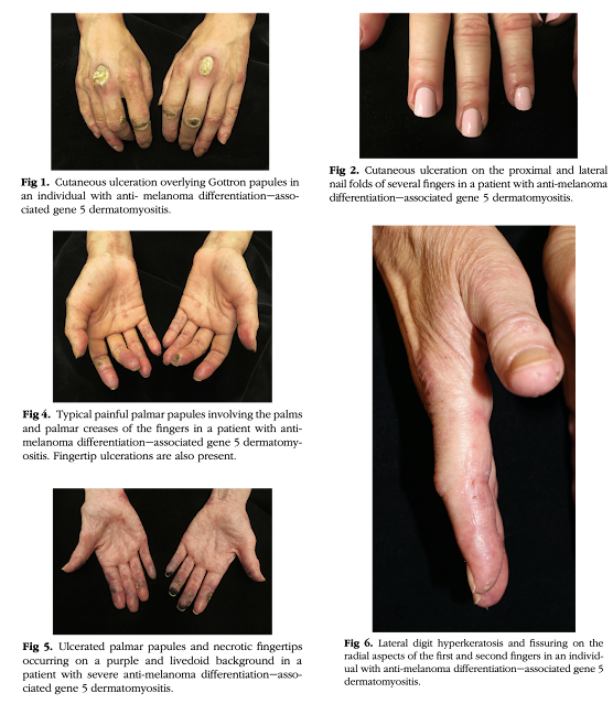 Hospitalist ~なんでも無い科医の勉強ノート~: 逆ゴットロン徴候: Inverse Gottron's sign/papule