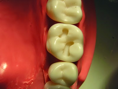 Operative Dentistry: Class I Cavity preparation & restoration on ...