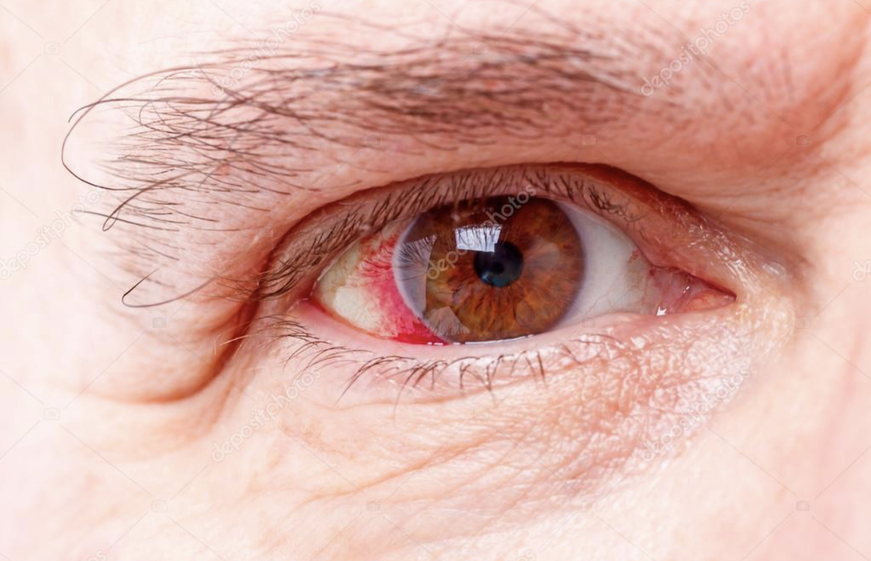 Hemorragia ocular