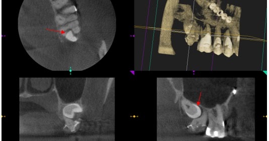 CBCT Scan: Maxillary Resorption by Tooth #1