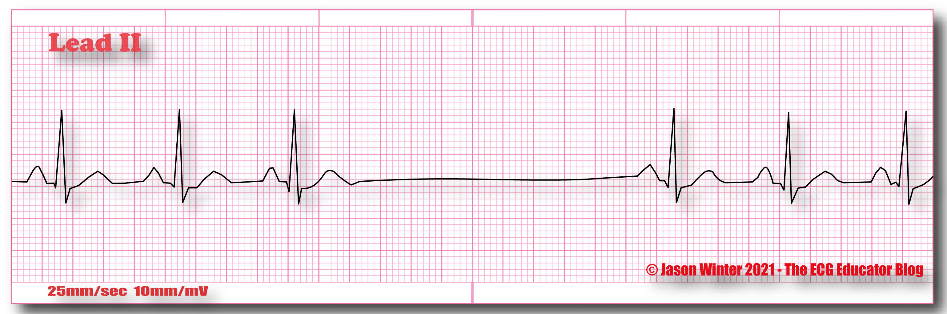 ECG Educator Blog : Sinus Arrest