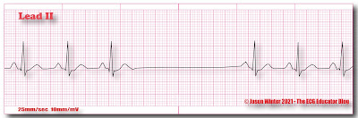 ECG Educator Blog : Sinus Arrest