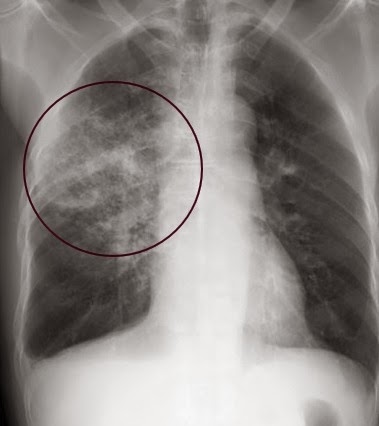 LAGG: RX DE TÓRAX PNEUMONIA