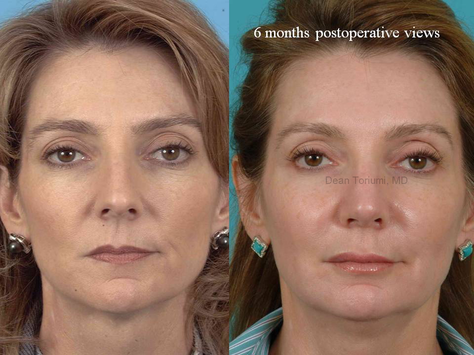 Dr. Dean Toriumi Reviews: Dean Toriumi Reviews: Patient presented for ...