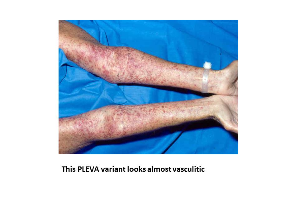 Consultations in Dermatology: Pityriasis Lichenoides PLEVA