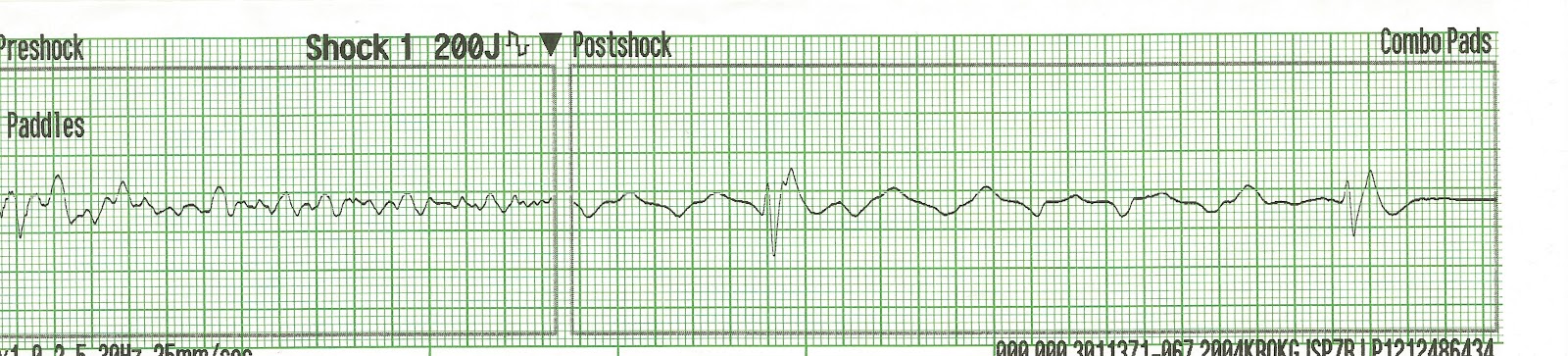 Code Blue: Refractory Ventricular Fibrillation