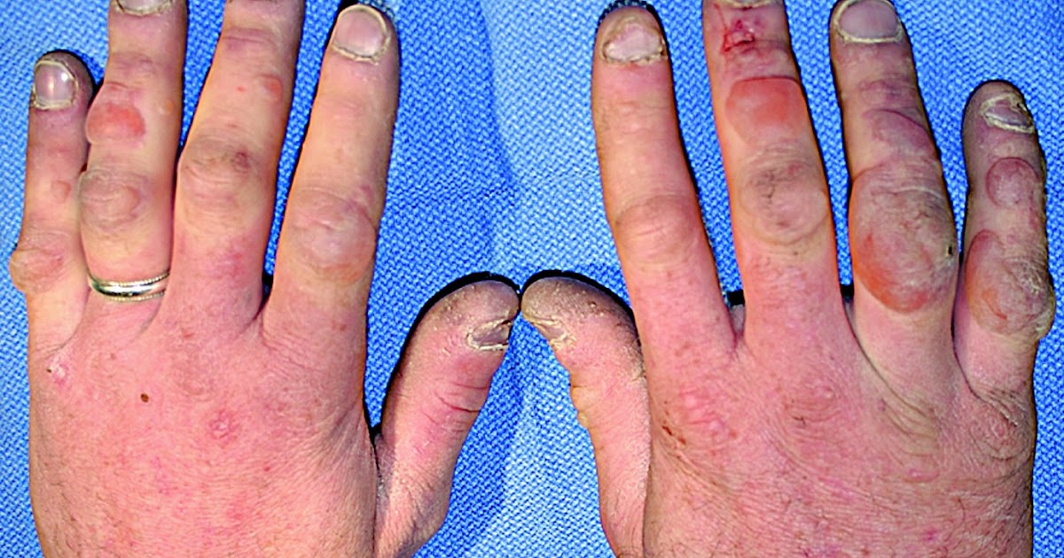 Tips and Knowledge: What is Frostbite?