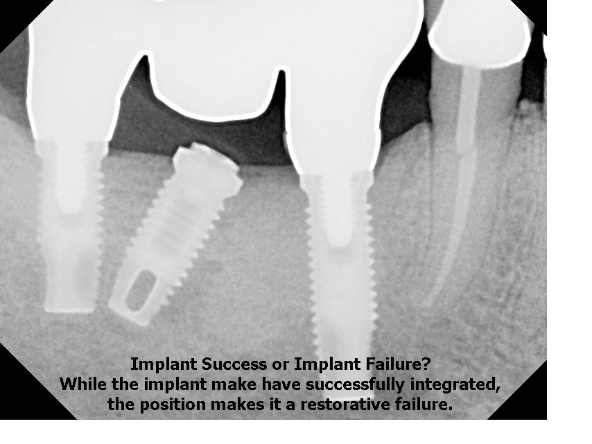 Pictures Of Dental Implants That Failed Find Local Dentist Near Your Area