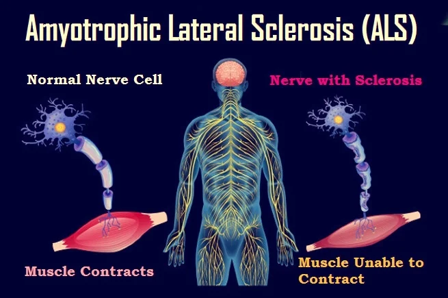 Amyotrophic Lateral Sclerosis (ALS) -Symptoms and Causes - How to ...