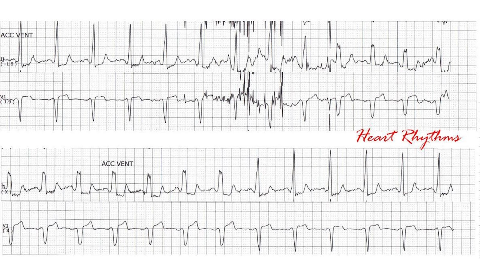 ECG Rhythms: Rate-dependent left bundle branch block