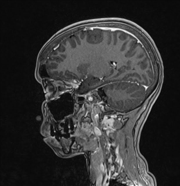 Ultimate Radiology : Hypertrophic Pachymeningitis