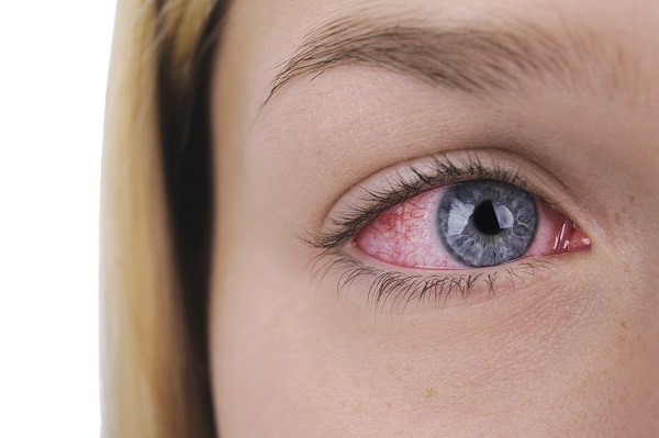 5 Types of Eye Irritation and Their Natural Remedies | HEALTHY and HAPPY