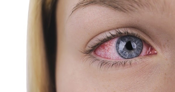 5 Types of Eye Irritation and Their Natural Remedies | HEALTHY and HAPPY