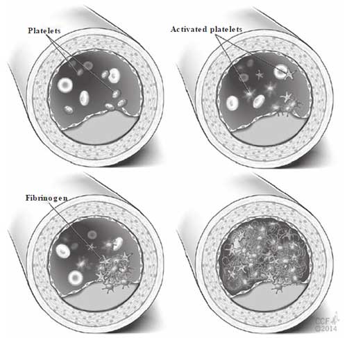 Anterior St Elevation Myocardial Infarction (STEMI) Case File