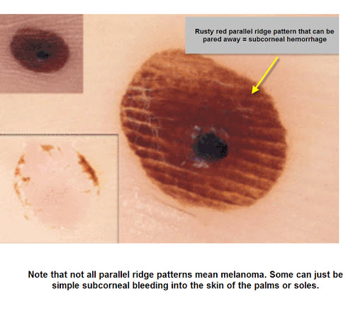 Dermoscopy Features as Clues: Lines parallel Ridges
