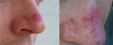 Rosacea Treatment Info : About red nose