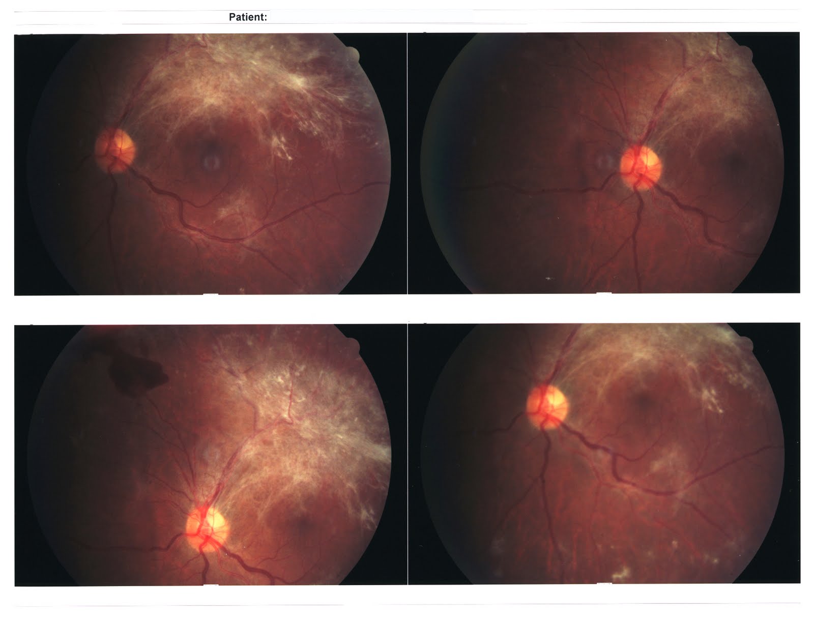 Case of the Day: Optometry: Gradual Blurred Vision OU for 6 months