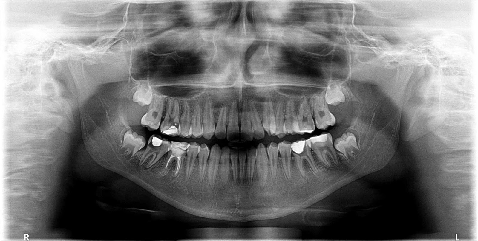Wojciech Bukowski chirurg dentysta: Kiedy usuwać ósemkę?