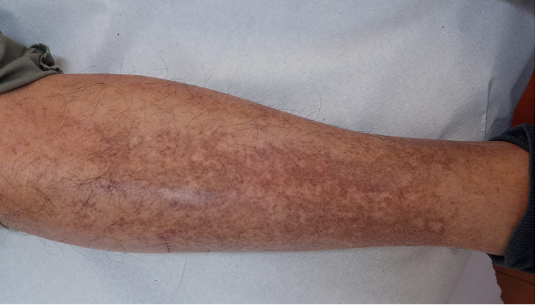 Derma-Docència Castelló: Mire cómo tengo las piernas... DERMATITIS OCRE