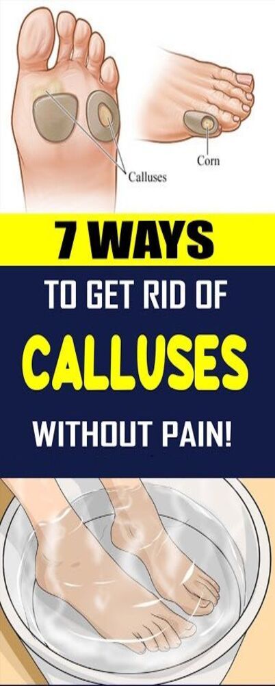 7 Ways To Get Rid Of Calluses Without Pain - wellness days