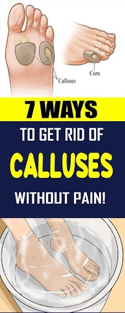 7 Ways To Get Rid Of Calluses Without Pain - wellness days