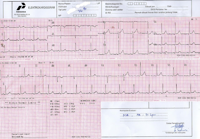 Medical Check Up: PEMERIKSAAN EKG