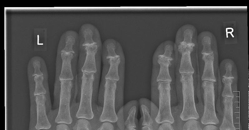 Rheumatologe: Arthrose Röntgenbilder der Hände - Osteoarthritis X-Rays ...