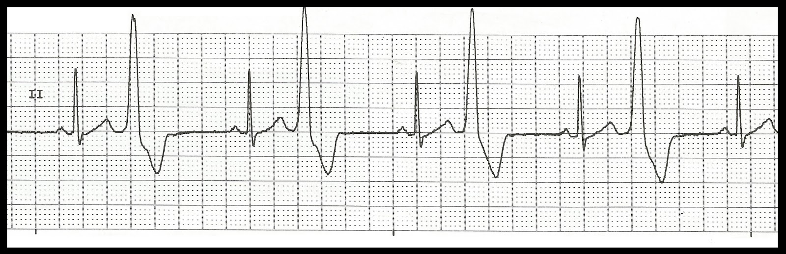Pvc Every Other Heartbeat at Christian Tudawali blog