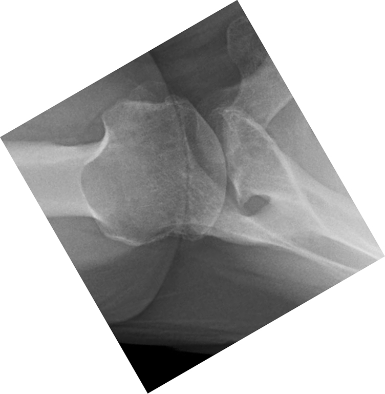 UW Shoulder and Elbow Academy: Glenoid retroversion ≠ subluxation, two ...
