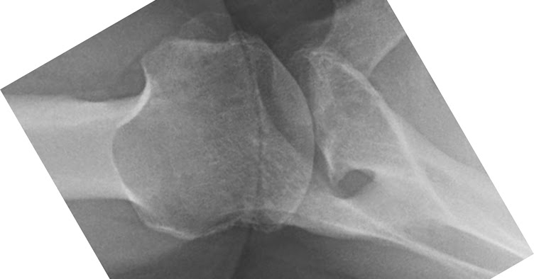 UW Shoulder and Elbow Academy: Glenoid retroversion ≠ subluxation, two ...