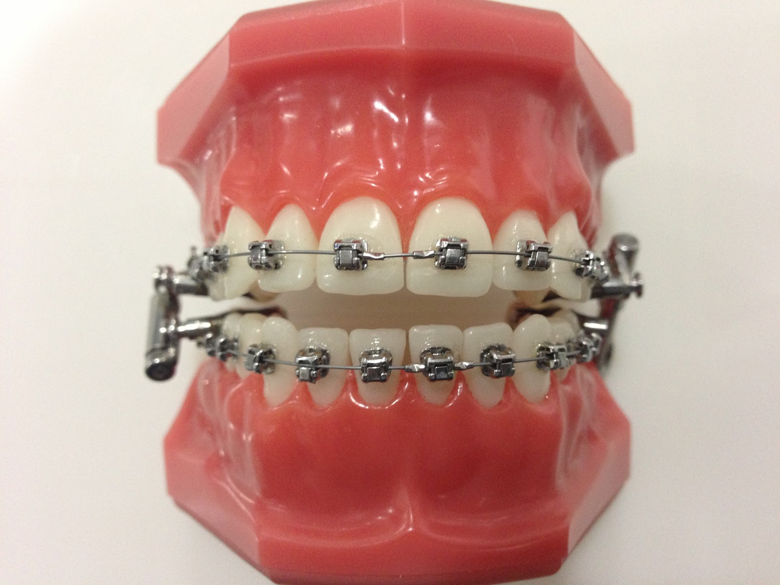 ORTODONCIA INVISIBLE HABIB BARHOUM: ADVANSYNC 2 - ORMCO