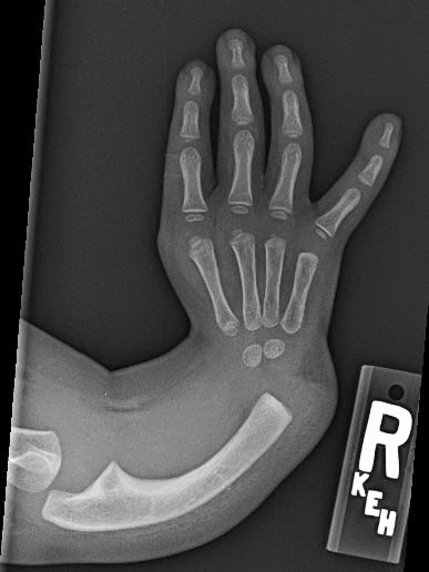 Radial Deficiency- Every Child is Unique | Congenital Hand and Arm ...