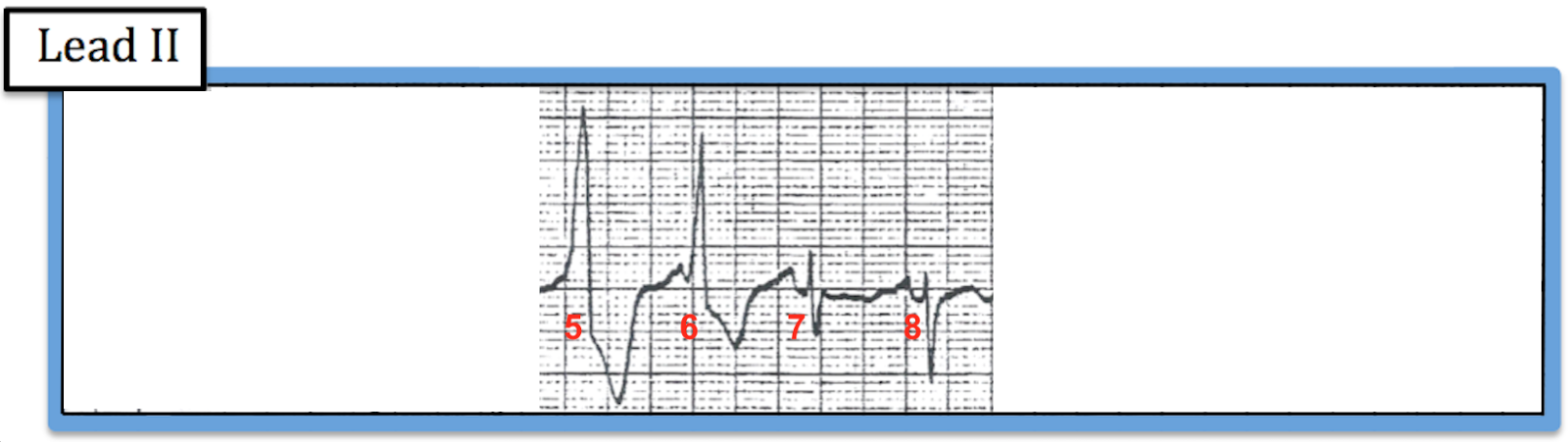 ECG Interpretation: ECG Blog #128 — VT, Fusion, WCT, Sinus Tach