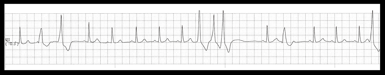 EKG Rhythm Quiz 229