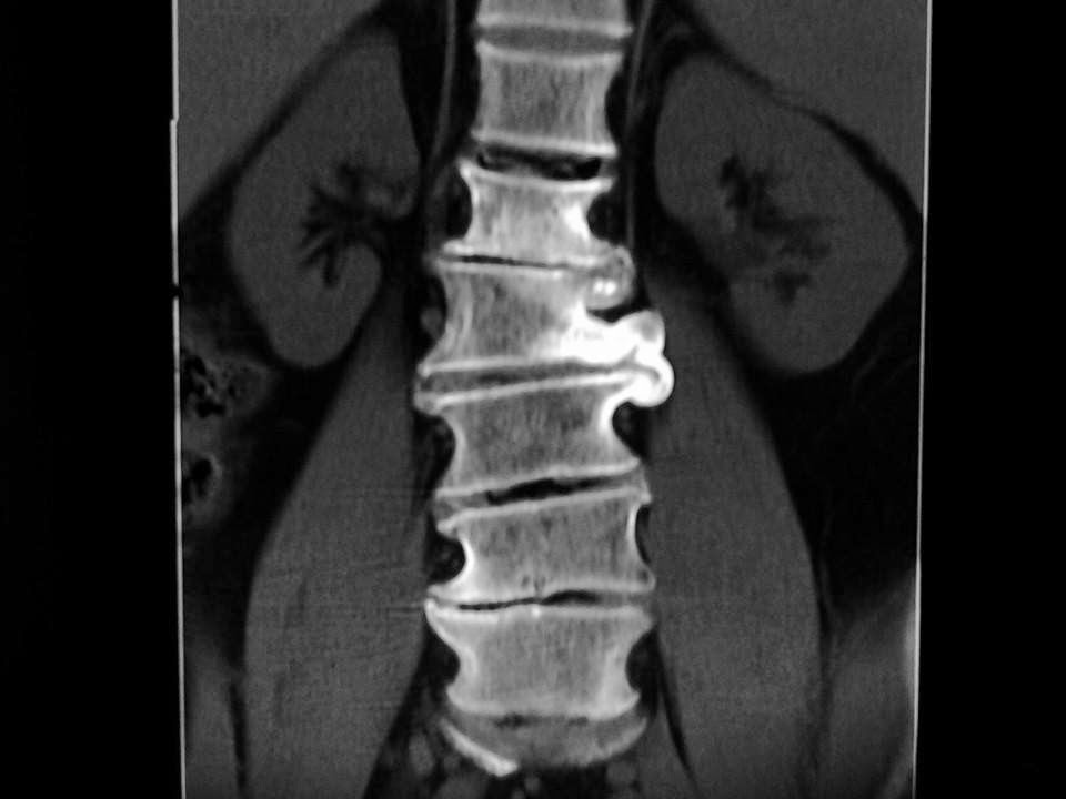 Movirsen: CASO CLÍNICO: Columna Lumbar