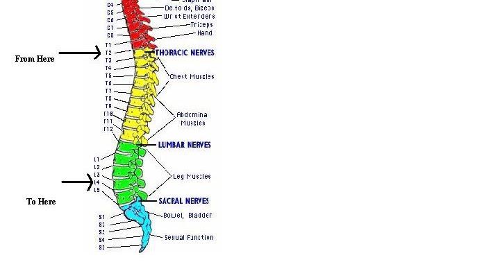 Scoliosis Surgery of Curly Back Chrissy: Length of Fusion T2 to L4