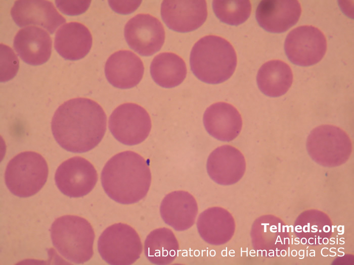 Hematología: Anormalidades Eritrocitarias