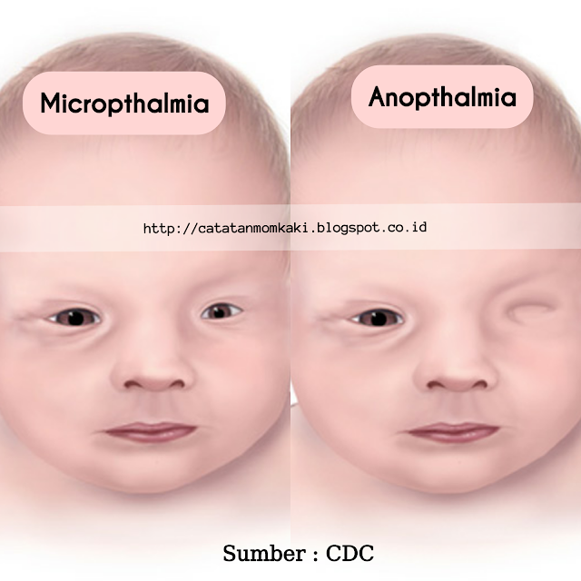 Mom2K's World: ANOPTHALMIA dan MICROPTHALMIA