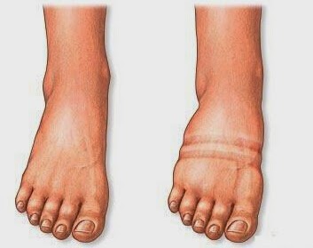 treatment for kidney disease: Does Swelling Means Chronic Kidney Disease