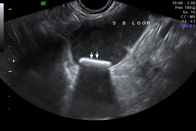 FOCAL SMALL BOWEL STRICTURE WITH SAIO & ENTEROLITHS - Sumer's Radiology ...