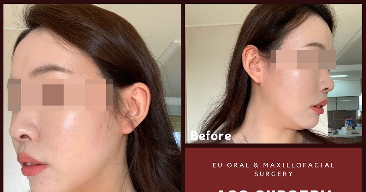 What is a Protruded Mouth?