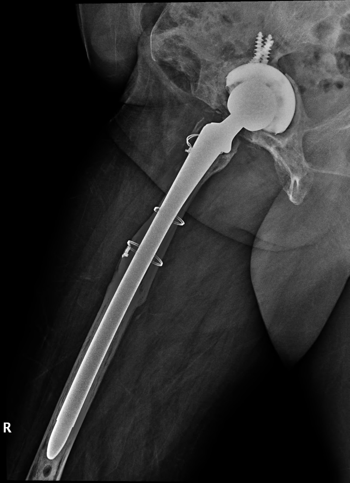 Joint Preservation and Replacement : hybrid technique in periprosthetic ...