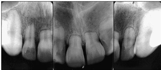 ORTODONCIA OJANGUREN: Reabsorciones Radiculares Parte I