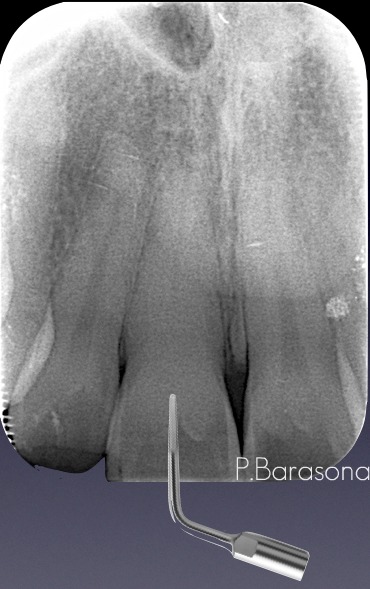 CONDUCTOS CALCIFICADOS