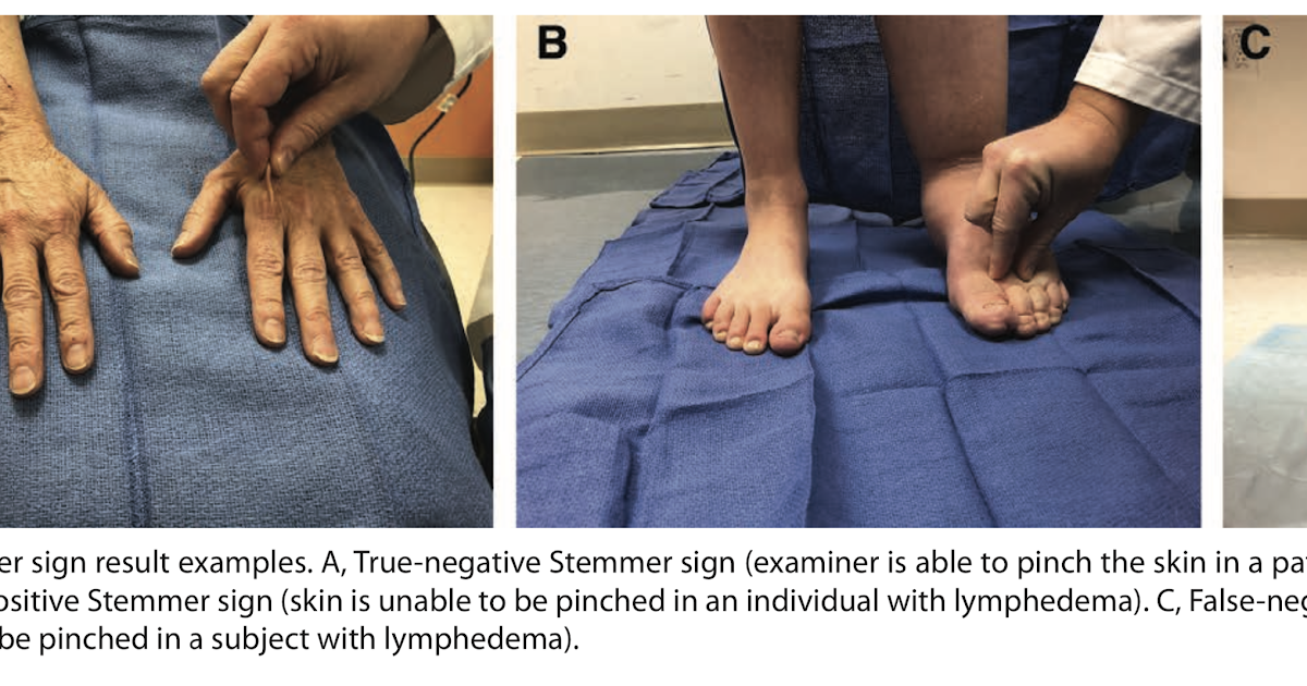 松下 ER ランチ・カンファレンス: シュテンマーサイン Stemmer sign