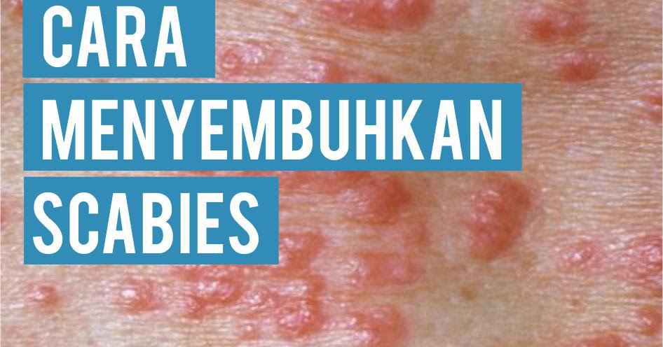 BAGAIMANA CARA MENYEMBUHKAN SCABIES ? | khairulleon.com Travel Blogger