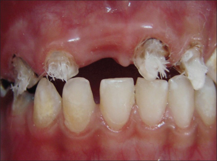Monoblock in Endodontics [Detailed Explaination with Studies]