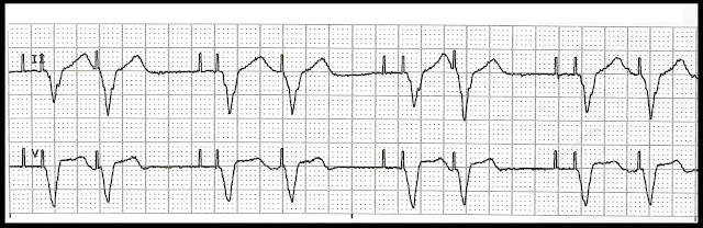 Practice ECG Rhythm Strips 114